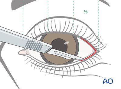 Lateral tarsorrhaphy for Irreversible paralysis, eye complex