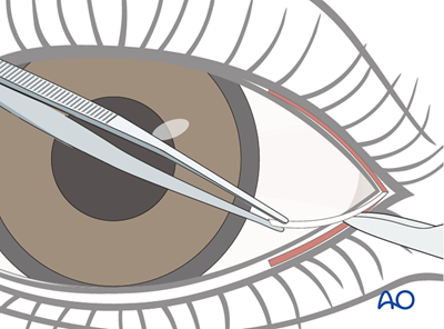 Lateral tarsorrhaphy for Irreversible paralysis, eye complex