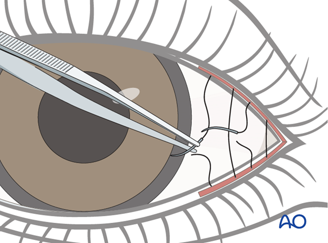 Lateral tarsorrhaphy for Irreversible paralysis, eye complex