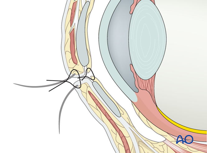 Lateral tarsorrhaphy for Irreversible paralysis, eye complex