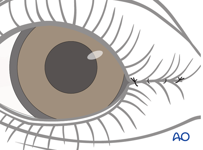 Lateral tarsorrhaphy for Irreversible paralysis, eye complex