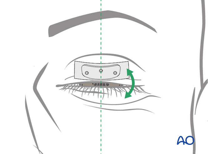 Upper eyelid weight for Irreversible paralysis, eye complex