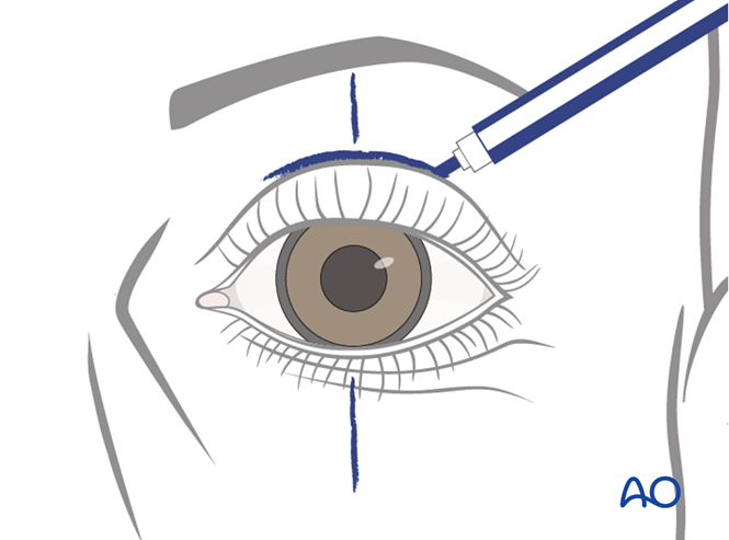 Upper eyelid weight for Irreversible paralysis, eye complex