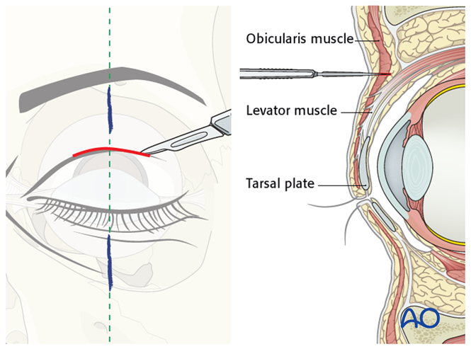 Upper eyelid weight for Irreversible paralysis, eye complex