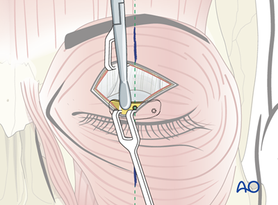 Upper eyelid weight for Irreversible paralysis, eye complex