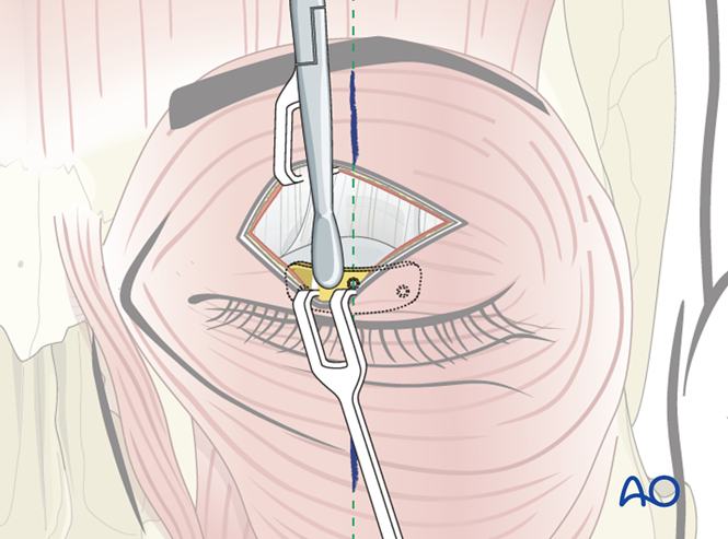Upper eyelid weight for Irreversible paralysis, eye complex