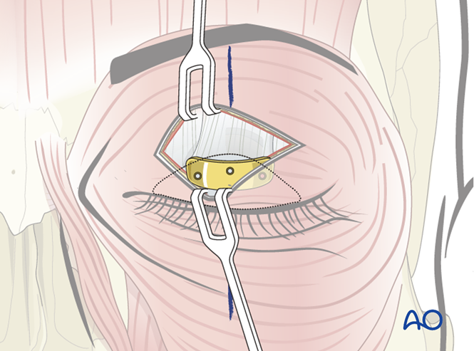 Upper eyelid weight for Irreversible paralysis, eye complex