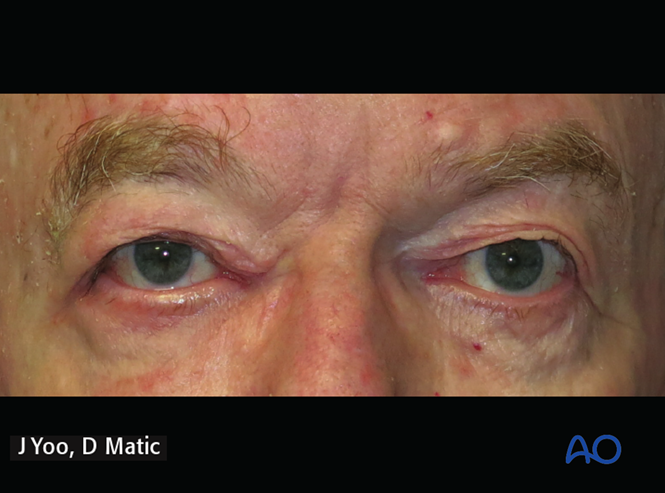 Lower eyelid - Tendon sling for Irreversible paralysis, eye complex