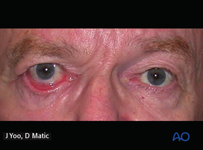 Lower eyelid - Tendon sling for Irreversible paralysis, eye complex