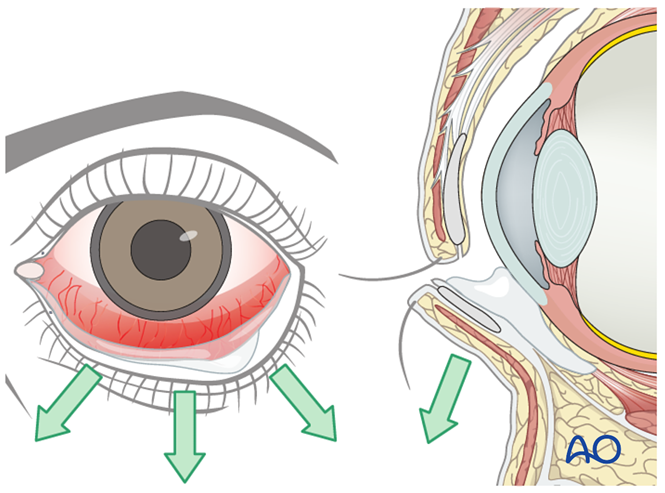 Lower eyelid - Tendon sling for Irreversible paralysis, eye complex