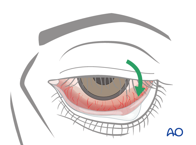 Lower eyelid - Tendon sling for Irreversible paralysis, eye complex