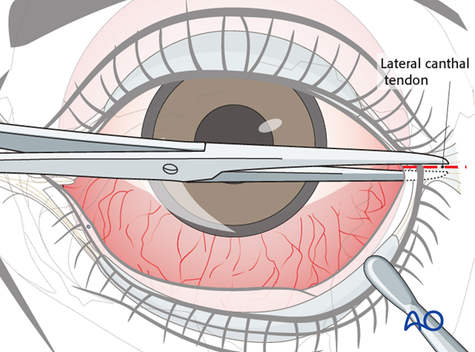 Lower eyelid - Lateral strip canthopexy for Irreversible paralysis, eye ...