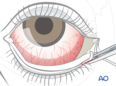 Lower eyelid - Lateral strip canthopexy for Irreversible paralysis, eye ...