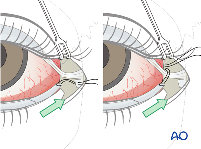 Lower eyelid - Lateral strip canthopexy for Irreversible paralysis, eye ...