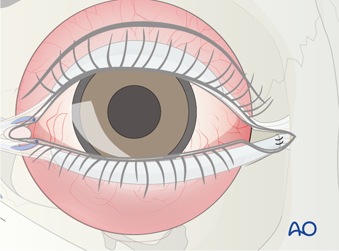 Lower eyelid - Lateral strip canthopexy for Irreversible paralysis, eye ...
