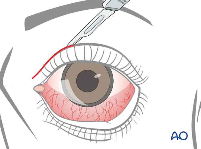 Lower eyelid - Tendon sling for Irreversible paralysis, eye complex
