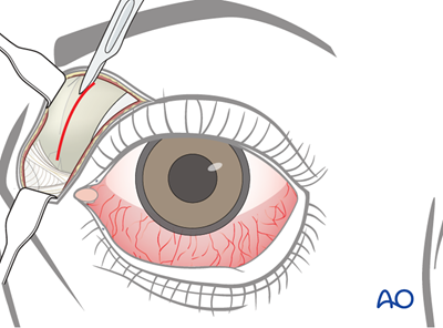 Lower eyelid - Tendon sling for Irreversible paralysis, eye complex