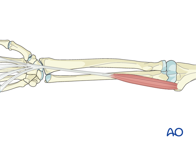 Lower eyelid - Tendon sling for Irreversible paralysis, eye complex