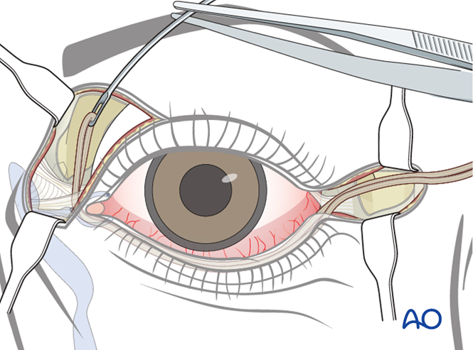 Lower eyelid - Tendon sling for Irreversible paralysis, eye complex