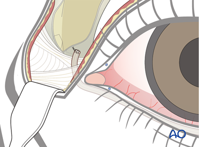 Lower eyelid - Tendon sling for Irreversible paralysis, eye complex