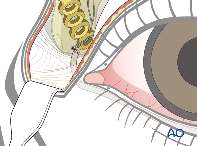 Lower eyelid - Tendon sling for Irreversible paralysis, eye complex