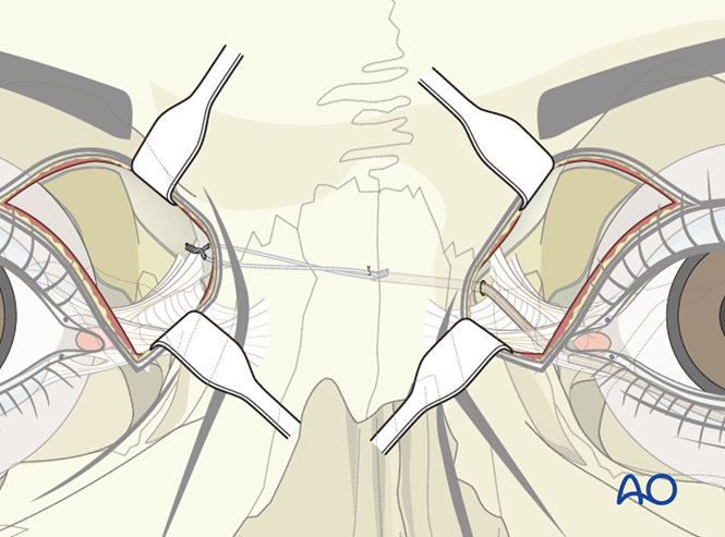 Lower eyelid - Tendon sling for Irreversible paralysis, eye complex