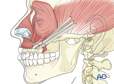 Static suspension with tendons for Irreversible paralysis, midface and ...