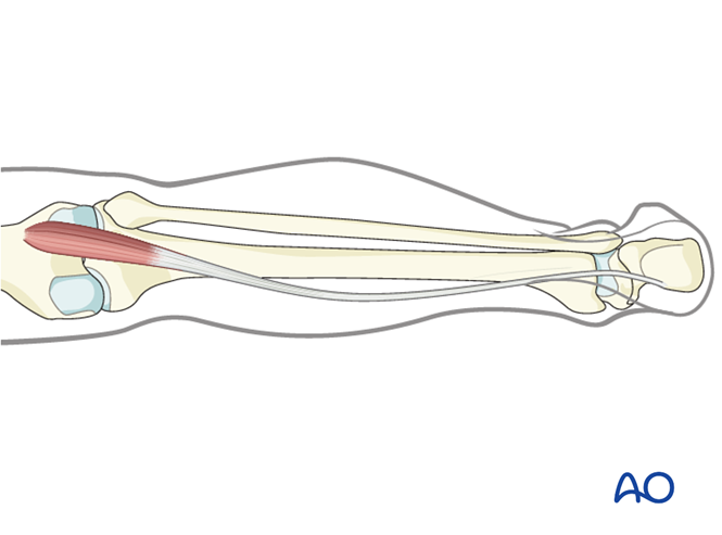 Static suspension with tendons for Irreversible paralysis, midface and ...