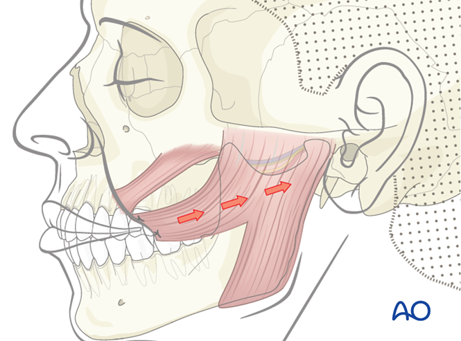 Masseter muscle transposition for Irreversible paralysis, midface and mouth