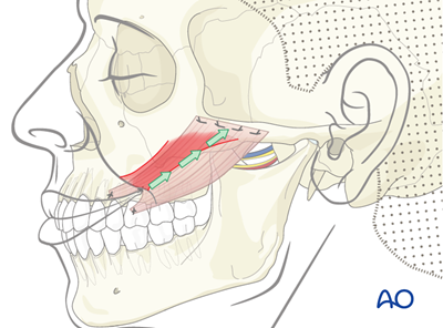 Masseter muscle transposition for Irreversible paralysis, midface and mouth