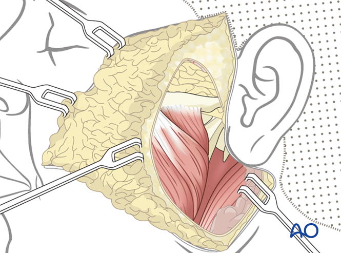 Masseter muscle transposition for Irreversible paralysis, midface and mouth