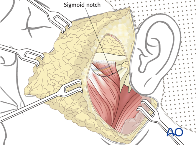 Masseter muscle transposition for Irreversible paralysis, midface and mouth