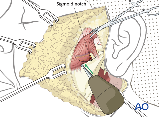 Masseter muscle transposition for Irreversible paralysis, midface and mouth