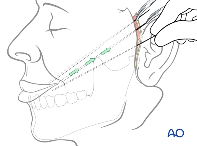 Masseter muscle transposition for Irreversible paralysis, midface and mouth