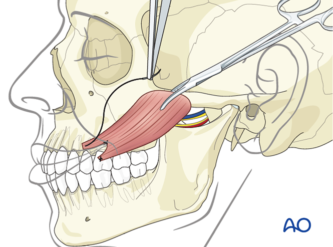 Masseter muscle transposition for Irreversible paralysis, midface and mouth