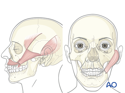 Temporalis muscle transposition for Irreversible paralysis, midface and ...
