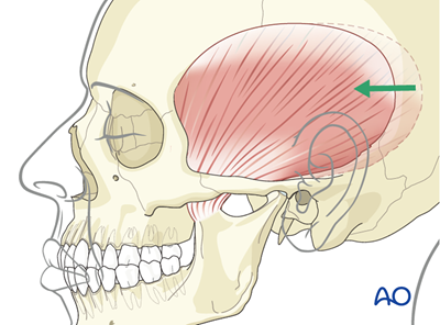 Temporalis muscle transposition for Irreversible paralysis, midface and ...