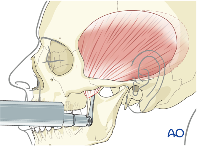 Temporalis muscle transposition for Irreversible paralysis, midface and ...