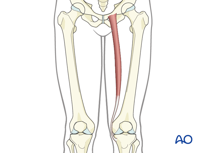 Innervated free muscle transfer (Gracilis) for Irreversible paralysis ...
