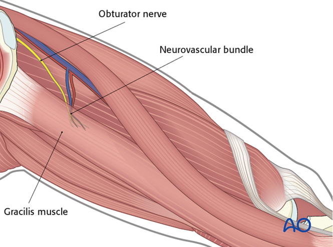 Innervated free muscle transfer (Gracilis) for Irreversible paralysis ...