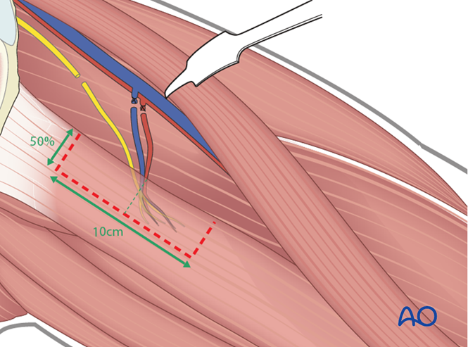 Innervated free muscle transfer (Gracilis) for Irreversible paralysis ...