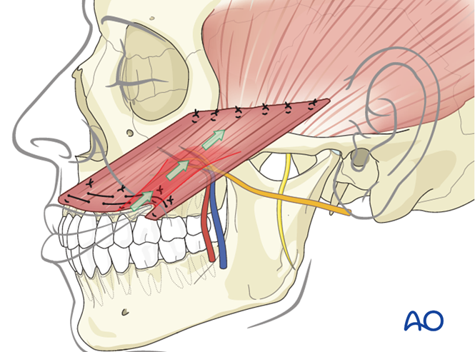 Innervated free muscle transfer (Gracilis) for Irreversible paralysis ...