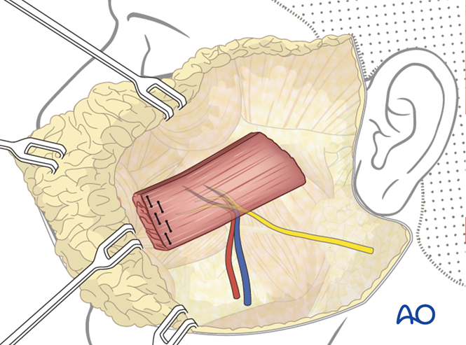 Innervated free muscle transfer (Gracilis) for Irreversible paralysis ...