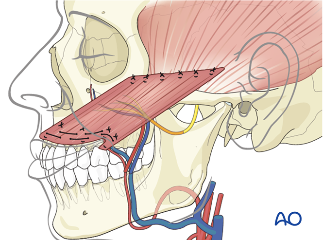 Innervated free muscle transfer (Gracilis) for Irreversible paralysis ...