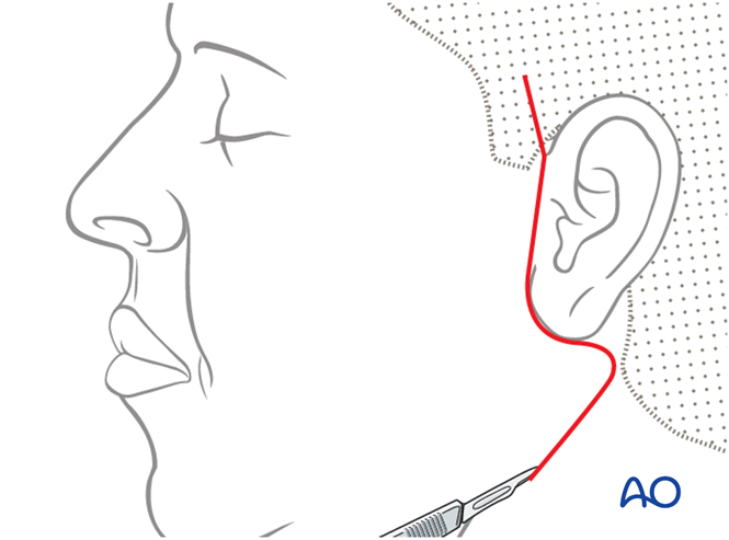 Innervated free muscle transfer (Gracilis) for Irreversible paralysis ...