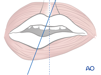 Horizontal shortening for Irreversible paralysis, mouth - Lower lip