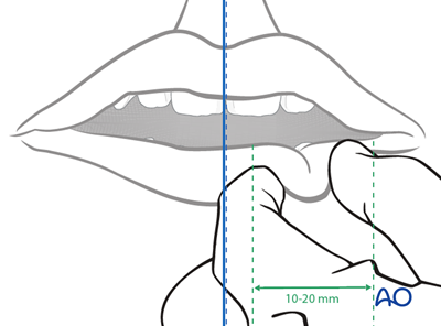 Horizontal shortening for Irreversible paralysis, mouth - Lower lip