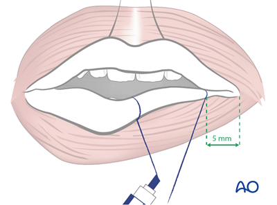 Horizontal shortening for Irreversible paralysis, mouth - Lower lip