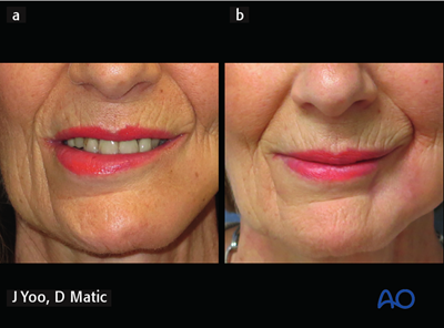 Horizontal shortening for Irreversible paralysis, mouth - Lower lip