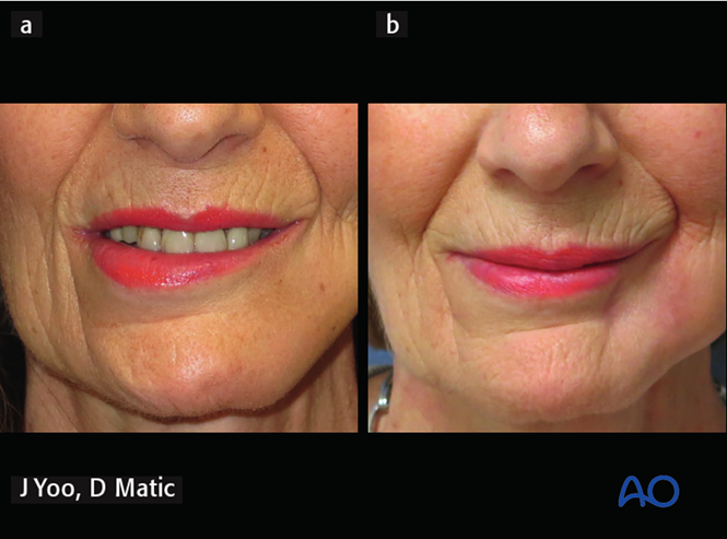 Horizontal shortening for Irreversible paralysis, mouth - Lower lip